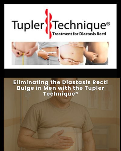 Eliminating the Diastasis Recti Bulge in Men with the Tupler Technique ...
