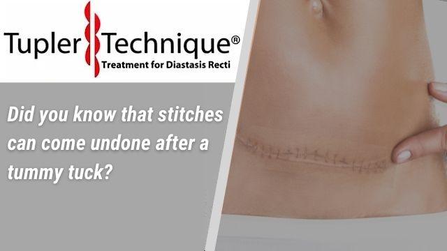Unraveling the Truth About Tummy Tucks: Why Stitches Can Come Undone ...